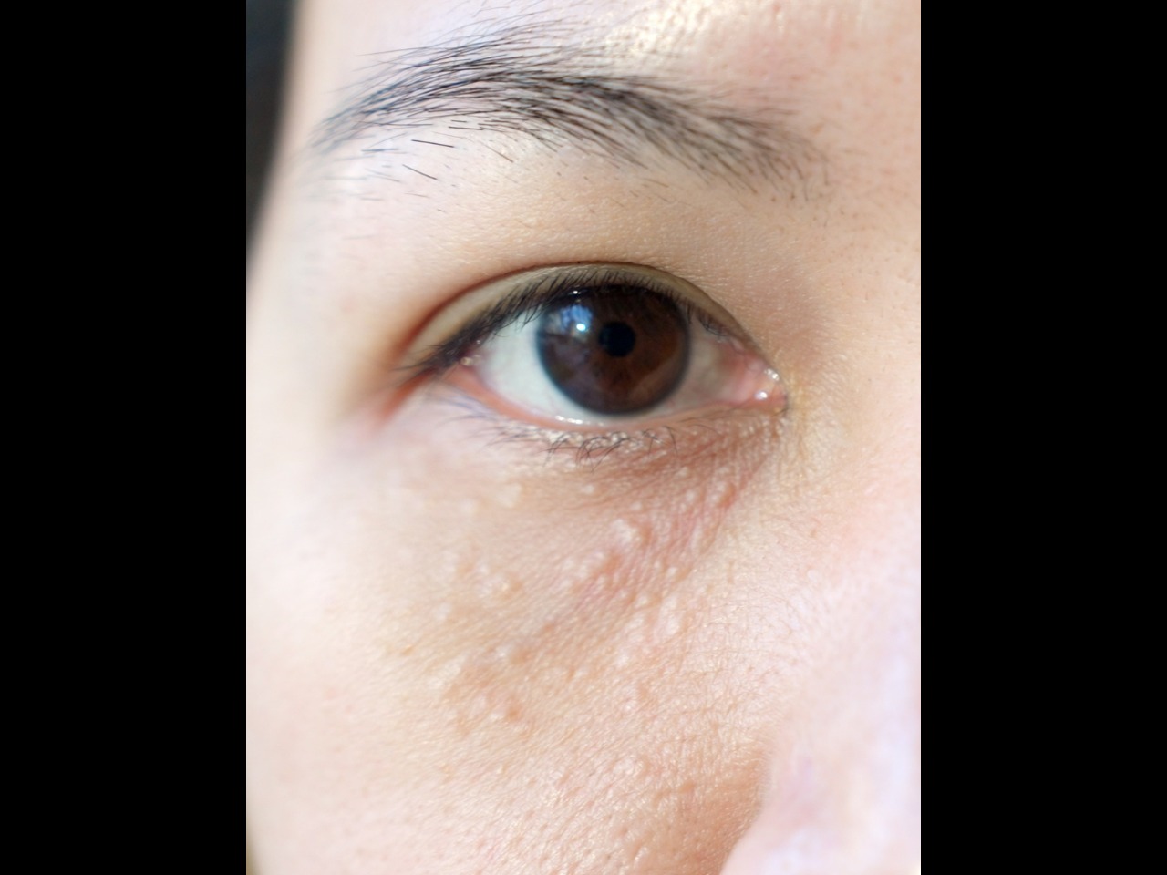 Kenali 5 Jenis Milia yang Bisa Terjadi Pada Anak-anak hingga Orang ...