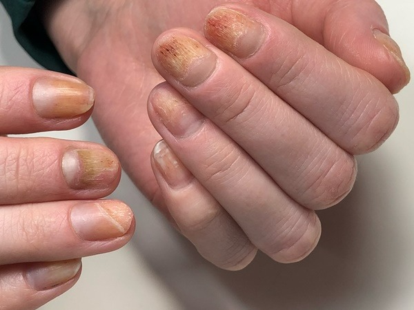 Perlu Kamu Tahu, Ternyata Ini Penyebab hingga Cara Mengatasi Infeksi ...