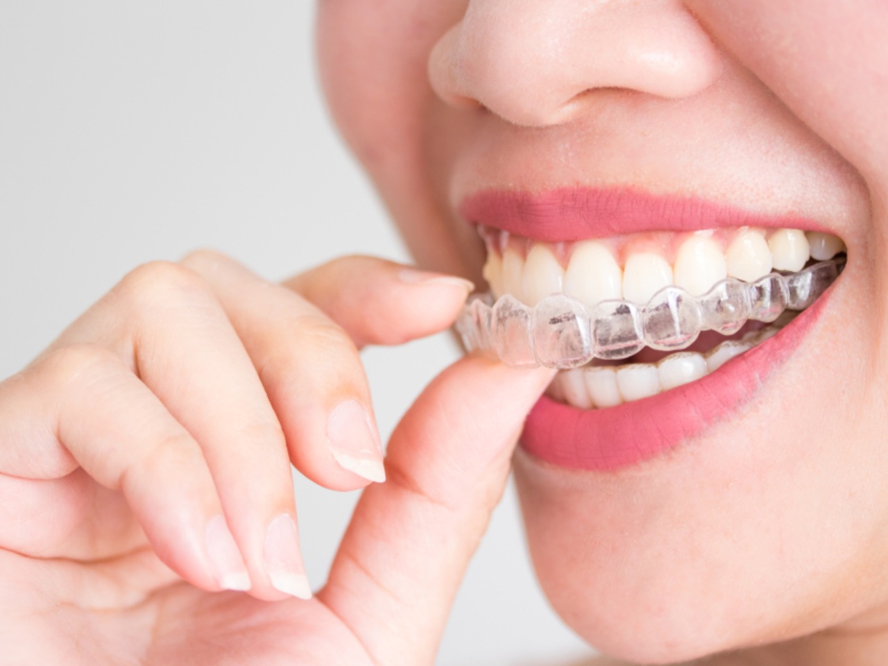 5 Hal yang Perlu Anda Ketahui Sebelum Menggunakan Invisalign - Beauty ...