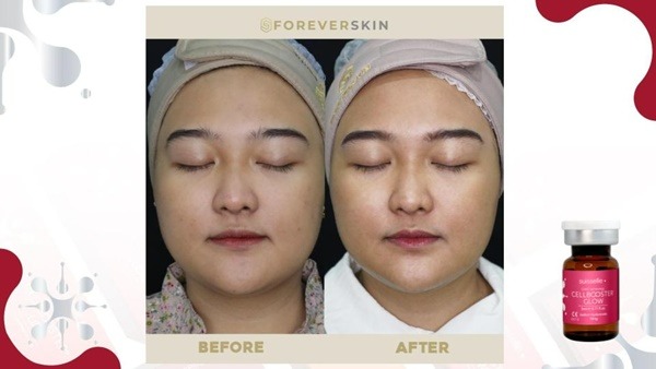 CELLBOOSTER®, Skin Booster yang Disebut Bisa Atasi Berbagai ...