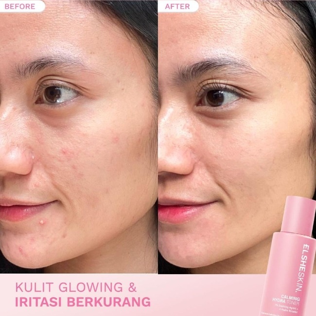 ELSHESKIN Calming Hydra Toner, Skincare Baru untuk Redakan Kemerahan ...