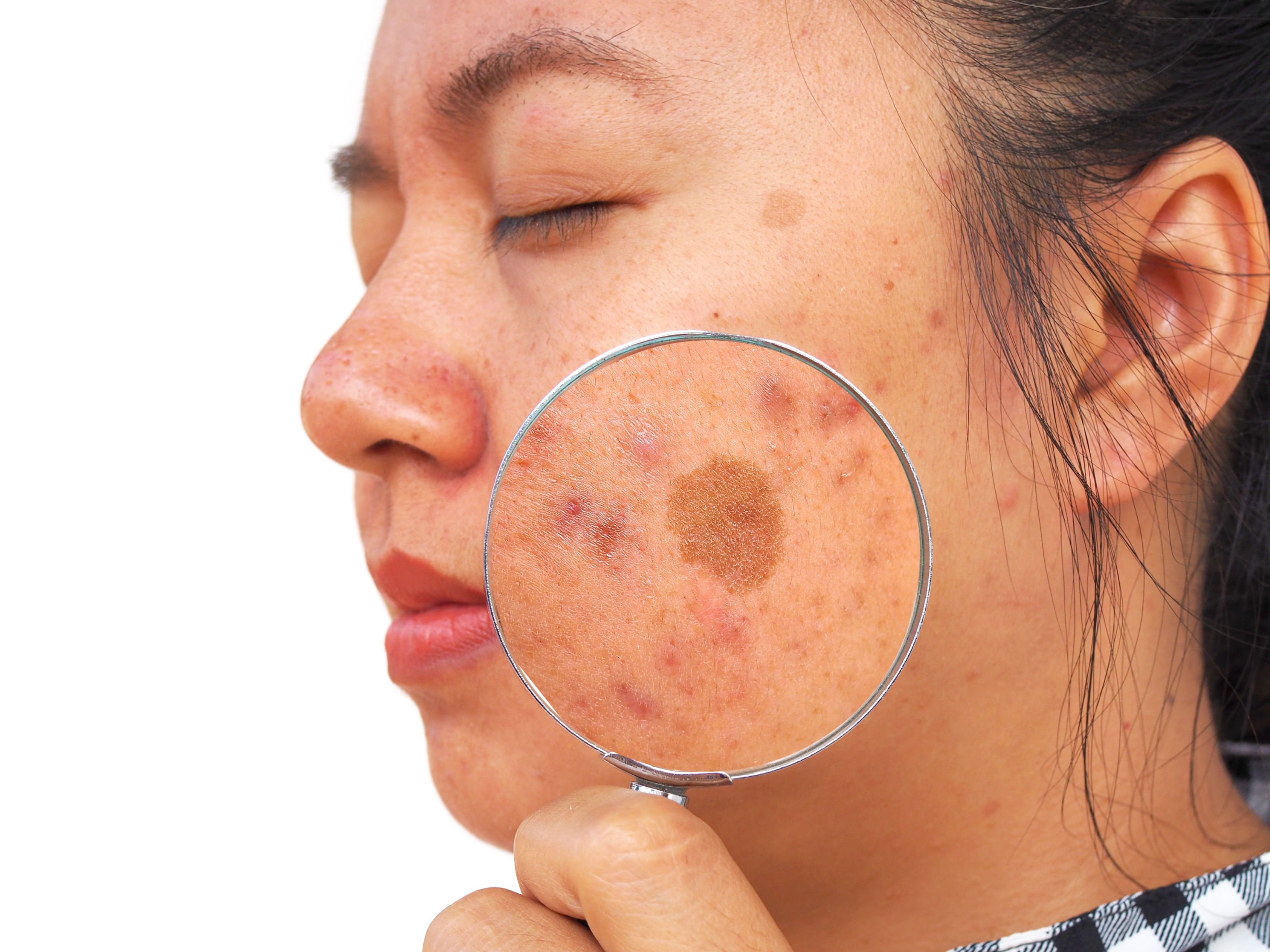 Hiperpigmentasi VS Melasma, Apa Bedanya? - SOCO by Sociolla