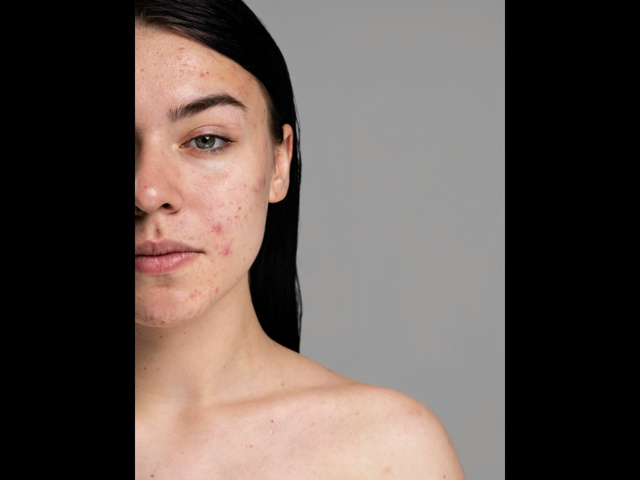 Mengenal Perioral Dermatitis, Masalah Kulit yang Disebut Menyerupai ...