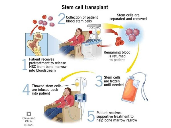 Ask The Experts: Apa Sebenarnya Treatment Stem Cell dan Manfaatnya ...