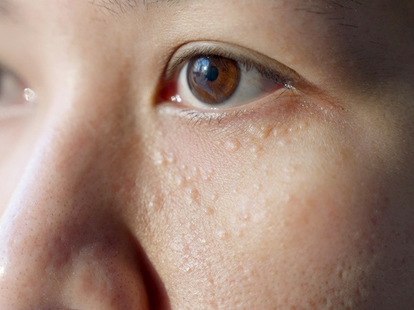 Kenali 5 Jenis Milia yang Bisa Terjadi Pada Anak-anak hingga Orang ...