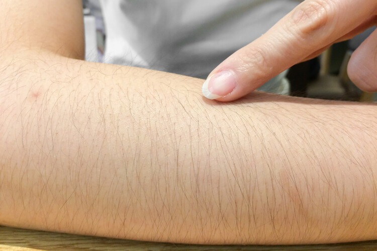 Mengenal Polycystic Ovary Syndrome (PCOS) serta Gejala yang Harus ...