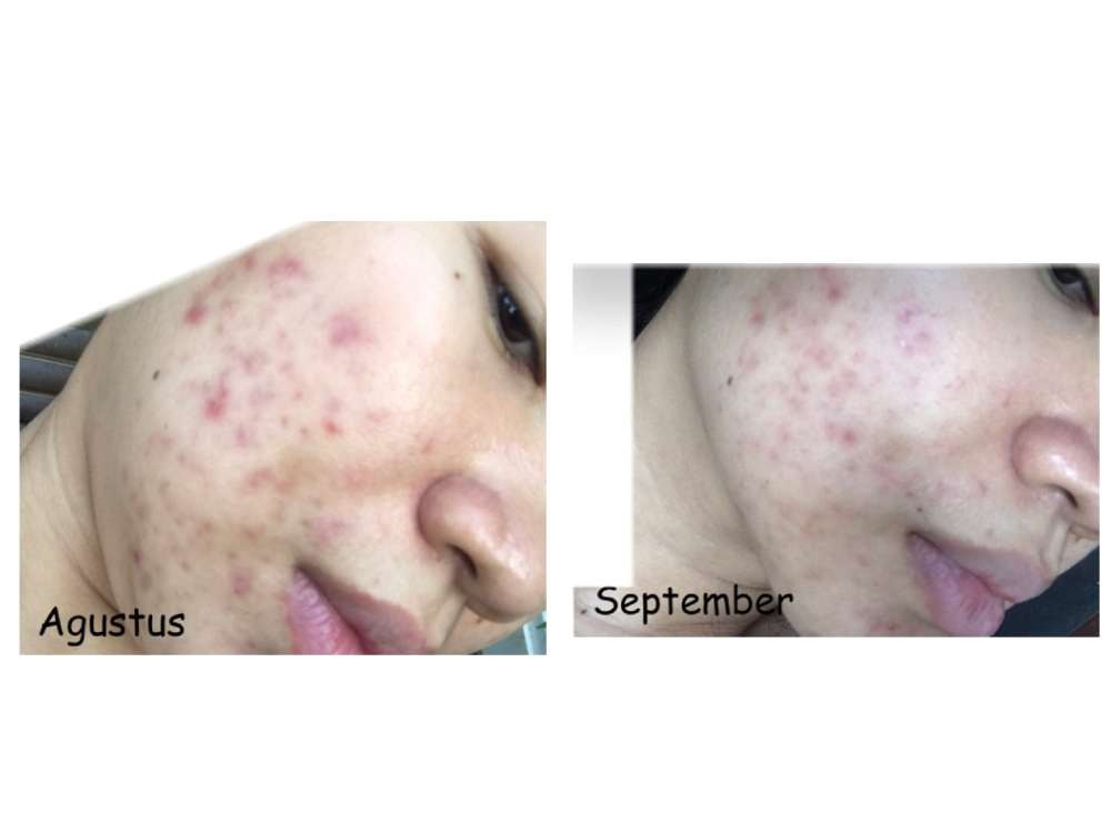 BJ Editors: Acne Journey Tim Editorial dan Cara Menghadapinya ...