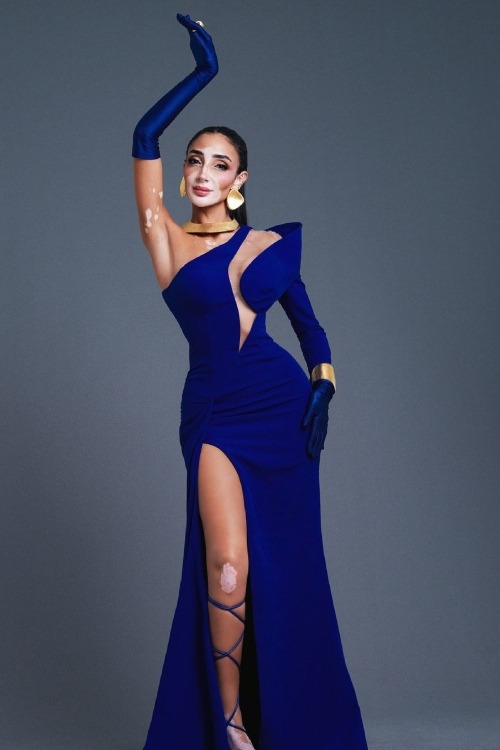 Mengenal Logina Salah, Kontestan Miss Universe Pertama yang Mengidap ...