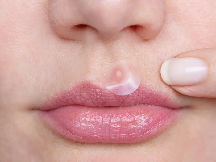 Tips Memilih Acne Patch yang Tepat Sesuai Jenis Jerawat untuk Dapatkan ...