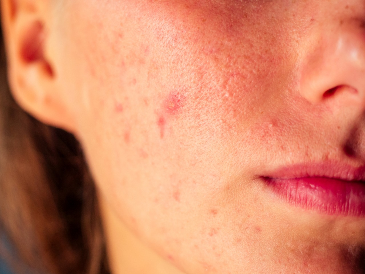 Heboh 'Acne Prank' Pakai Filter Jerawat, Ini Tanggapan Warganet ...