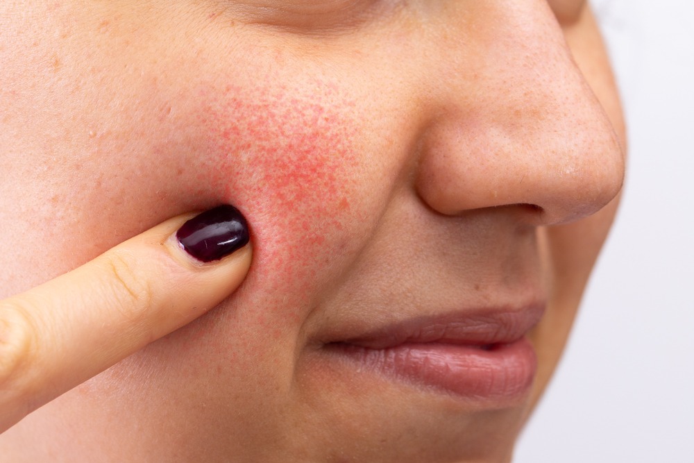 Kulit Kasar dan Kemerahan? Kenali 5 Tanda Kulit Sensitif dan Produk ...