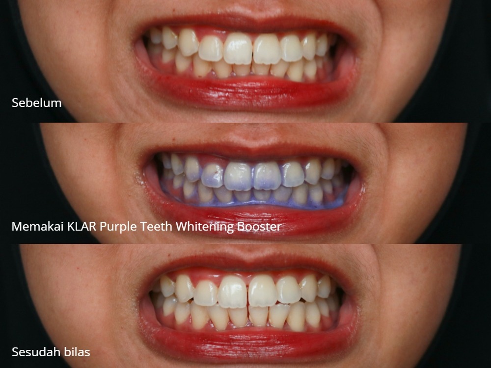 Review: KLAR Purple Teeth Whitening Booster, Benarkah Bisa Bikin Gigi ...
