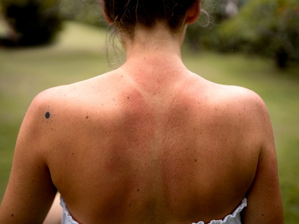 10 Kondisi Kulit yang Bisa Membuat Kulit Menjadi Kemerahan & Perlu ...