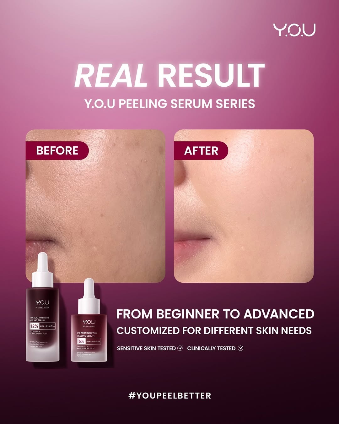 Baru! Peeling Serum Y.O.U Hadir dalam 2 Varian Berbeda untuk Setiap ...