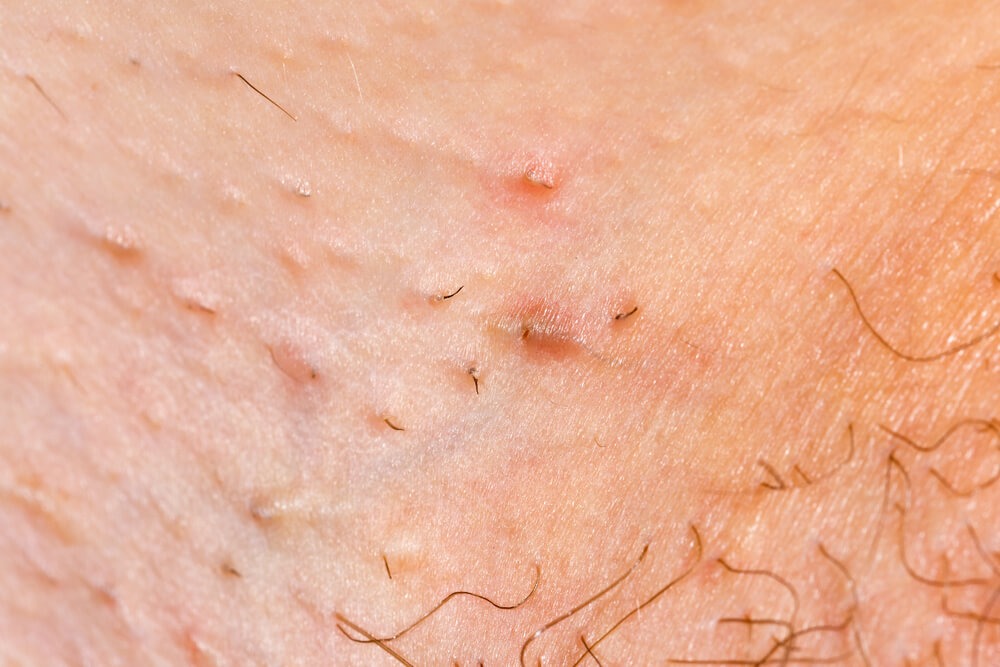 Dari Ingrown hingga Chicken Skin, Yuk, Ketahui Berbagai Masalah Kulit ...