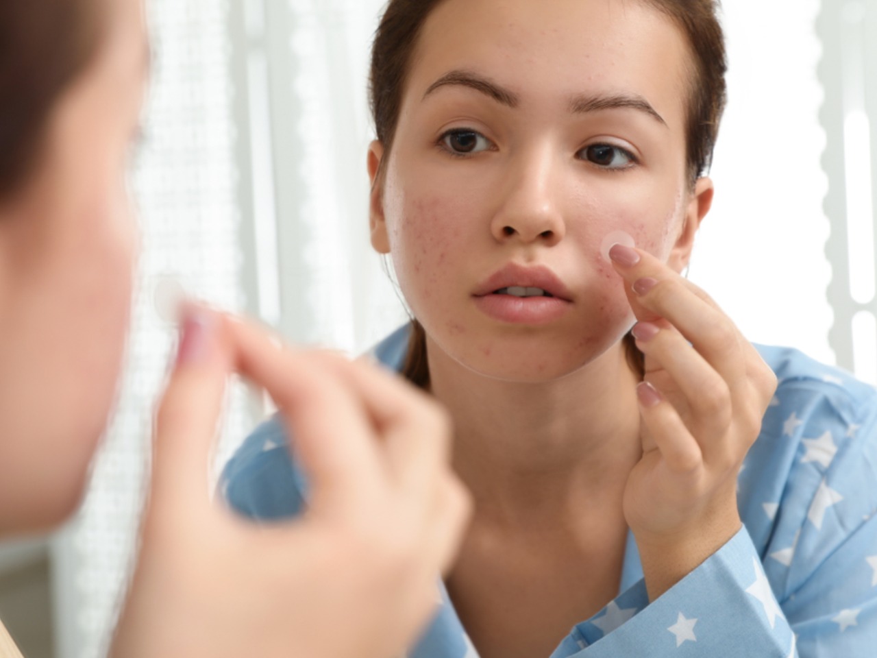 Rekomendasi Acne Patch dari Brand Korea yang Ampuh Atasi Jerawat ...