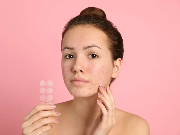 Tips Memilih Acne Patch yang Tepat Sesuai Jenis Jerawat untuk Dapatkan ...