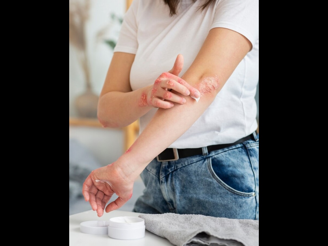 Bersama PERDOSKI, LABORÈ Hadirkan Skincare untuk Atasi Gejala Eksim dan ...