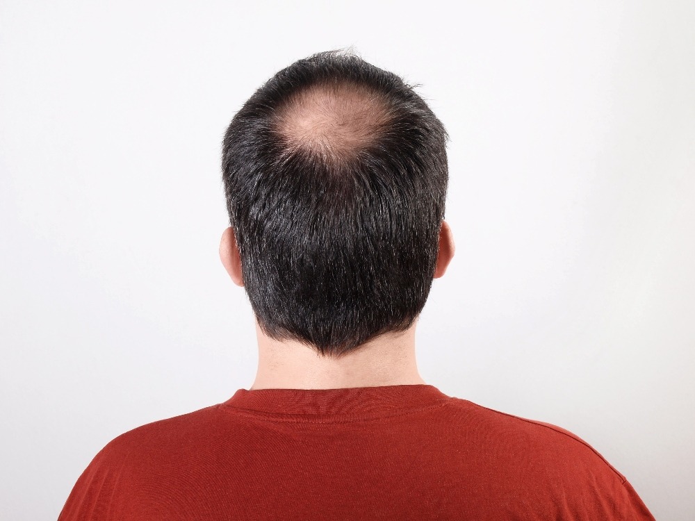 Kurang Percaya Diri Akibat Kepala Pitak? Treatment Ini Bisa Jadi ...