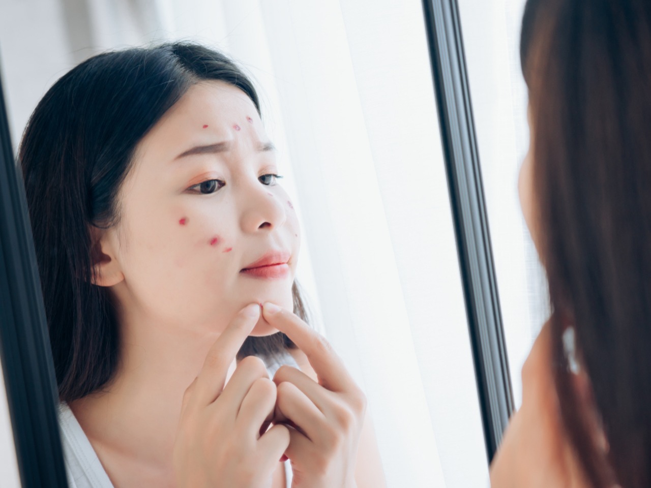 Selain Minyak, Ini 5 Kandungan Skin Care yang Patut Dihindari Pemilik Kulit Berjerawat - Beauty ...