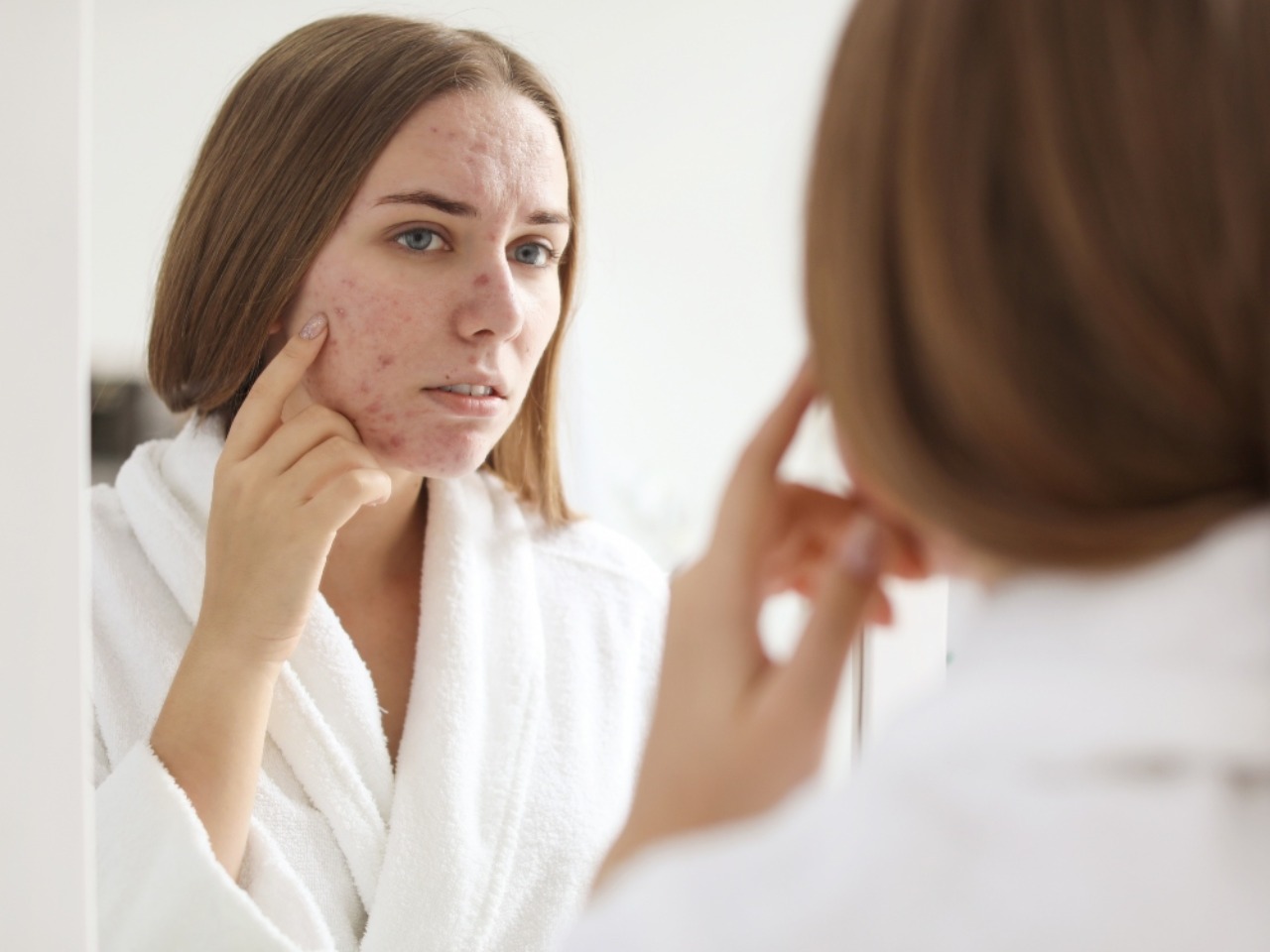 5 Langkah Sederhana Merawat Kulit Berjerawat dengan Produk Lokal ...
