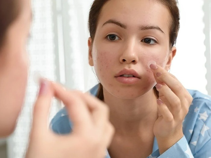 Tips Memilih Acne Patch yang Tepat Sesuai Jenis Jerawat untuk Dapatkan ...