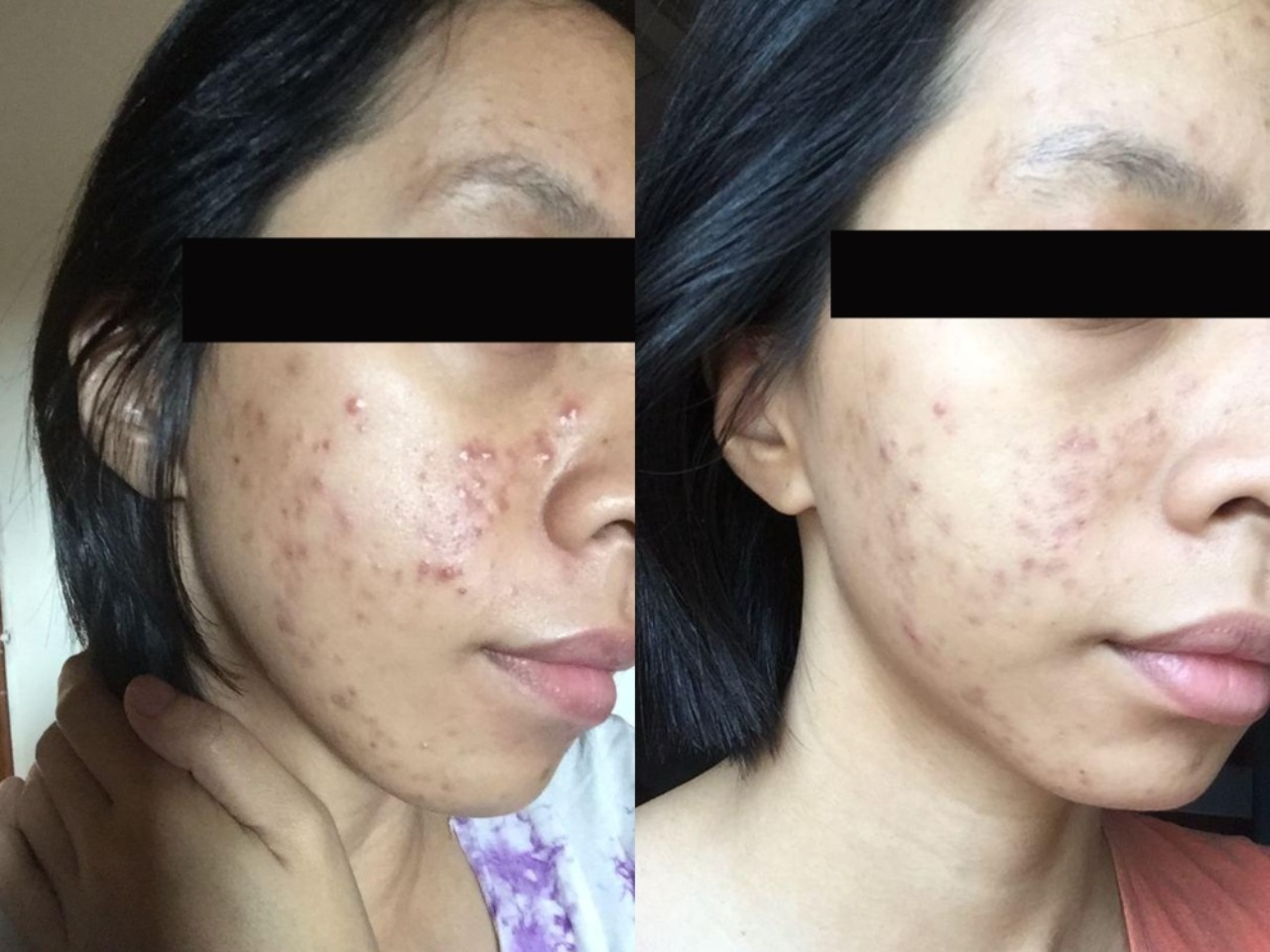 Review: Pengalaman Atasi Maskne yang Berangsur Membaik dengan Rangkaian ...