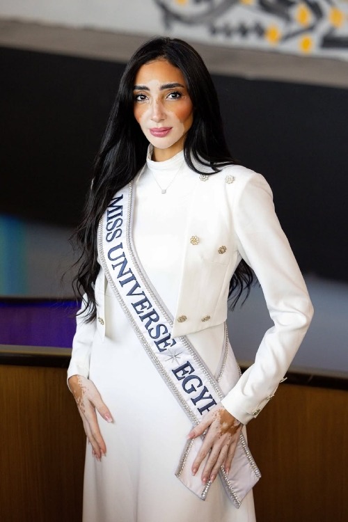 Mengenal Logina Salah, Kontestan Miss Universe Pertama yang Mengidap ...