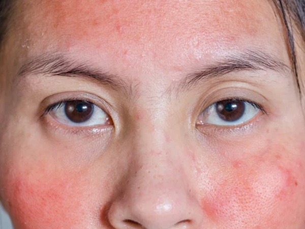 10 Kondisi Kulit yang Bisa Membuat Kulit Menjadi Kemerahan & Perlu ...